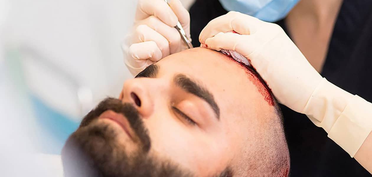 Best Hair Transplant Technique: FUT, FUE, DHI vs. FUE Sapphire - Prime ...